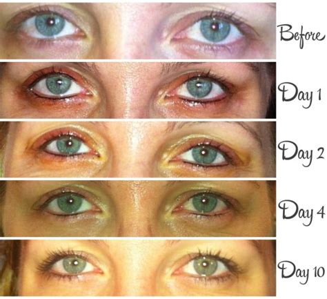 Permanent Eyeliner Healing Process At Sean Chaffey Blog