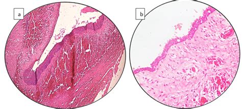 A Cyst Lining And Connective Tissue Wall Showing Nerve Bundles And