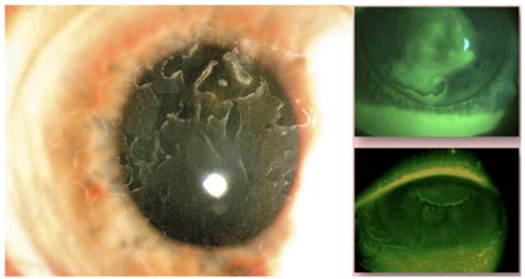 Corneal Dystrophies Flashcards Quizlet