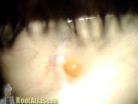 Pyogenic Granuloma On Eye Youtube