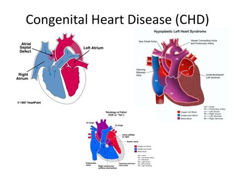 What Causes Chd In Newborns At Tina Lown Blog