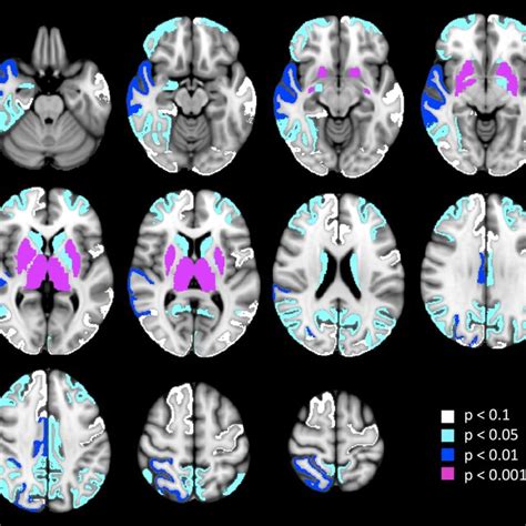 Average Mean Diffusivity Md In Sporadic Creutzfeldt Jakob Disease Download Scientific Diagram