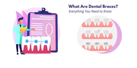 All You Need To Know About Dental Braces Types Cost How They Work And