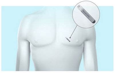 Medtronic LINQ Remoterhythm