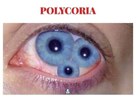 Polycoria Is A Pathological Condition Of The Eye Characterized By More