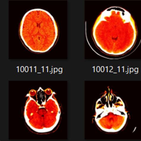 Brain Stroke Dataset Colorized Teknofest 2021 Kaggle