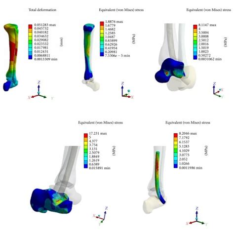 Pdf New Technique For Tibiotalar Arthrodesis Using A New Intramedullary Nail Device A