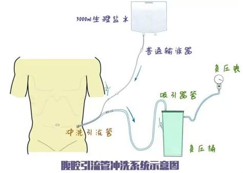 画说引流管：教你轻松搞定腹腔冲洗（第二节） 安骏医疗