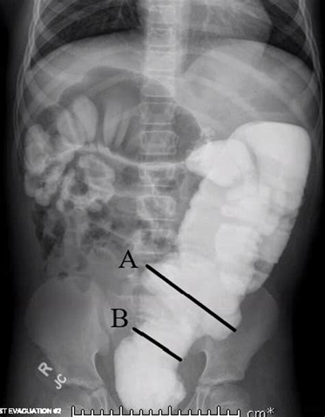 Contrast Enema Study With Demonstration Of Transition Zone At