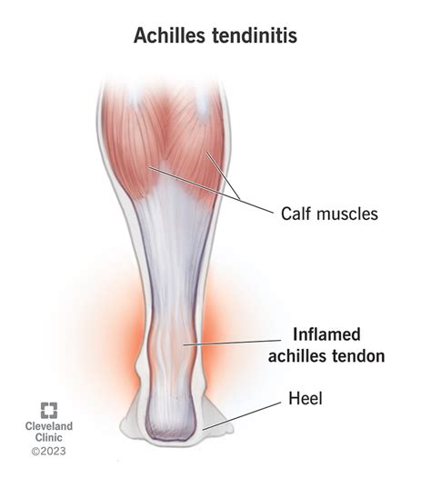 Achilles Tendonitis The Signs Of Achilles Tendinitis