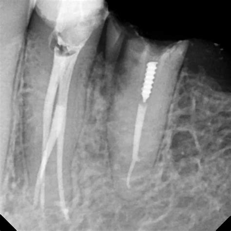 ‎دکتر سید حمید رضا داودی‎ Nonsurgical Rootcanal Retreatment Of Tooth No14 Preparation Done To