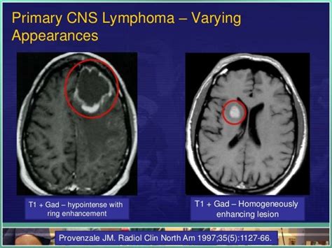 Ring Enhancing Lesions