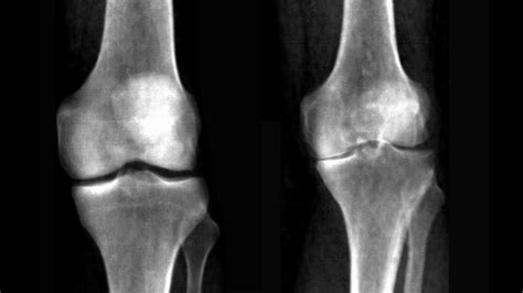 Osteoarthritis Knee Xray