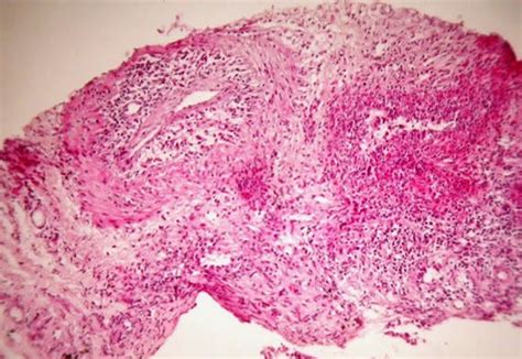 Wegeners Granulomatosis Presenting With Bilateral Excavated Nodules