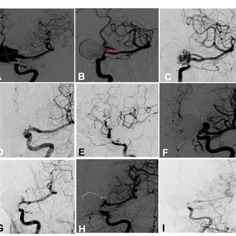 Figure A Woman In Her Rr S Had A Posterior Communicating Artery Pcom