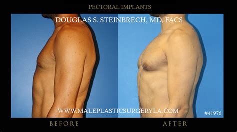 Male Enhancement Surgery