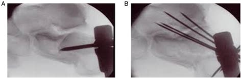 Reduction And Fixation Of A Fracture With Kirschner Wires Download