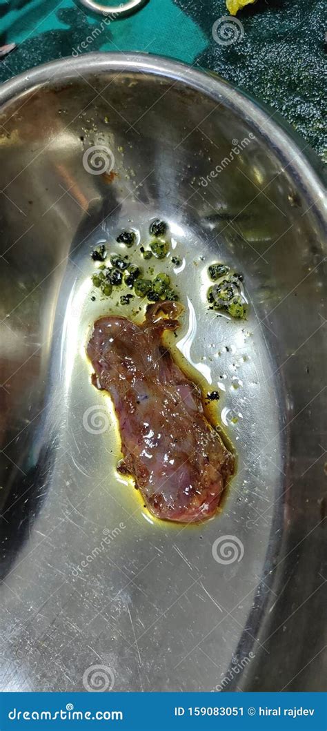 Gall Bladder Pigmented Stone Stock Image Image Of Gallstone Bladder