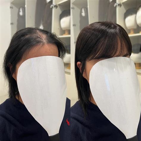 부산 가발 정수리 탈모 정수리 커버 여자 부분 가발 추천 네이버 블로그