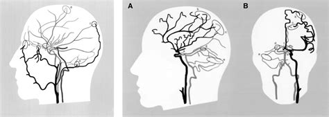 Cerebral Collateral Circulation In The Era Of Reperfusion Therapies For
