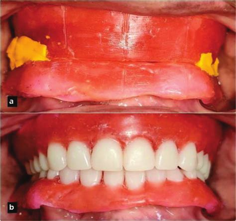 Maxillary And Mandibular A Primary Impression B Secondary