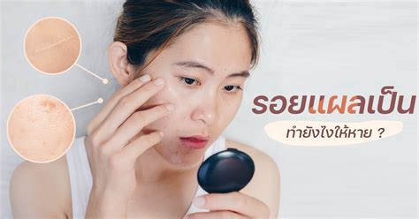 วธลบรอยแผลเปนบนใบหนา ทำยงไงใหหาย มาดวธกน
