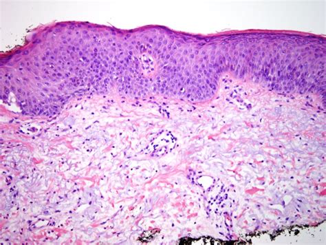 Melanoma In Situ With Ulcer Dermatopathology