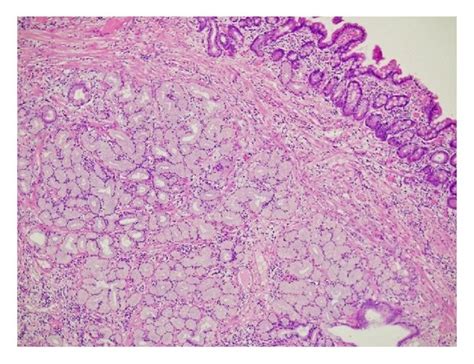 Pathological Images Stromal Cell Proliferation And Lobular Arrangement