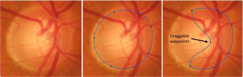 Figure 3 From A Method For Quantifying Sectoral Optic Disc Pallor In