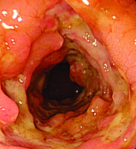 Ulcers And Pseudopolyps Of The Colon Download Scientific Diagram