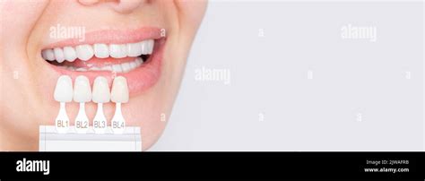 Teeth Whitening Dentist Bleach At James Silvers Blog