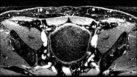 Isotropic Volumetric T1 Dixon Mri Of The Pelvis Youtube