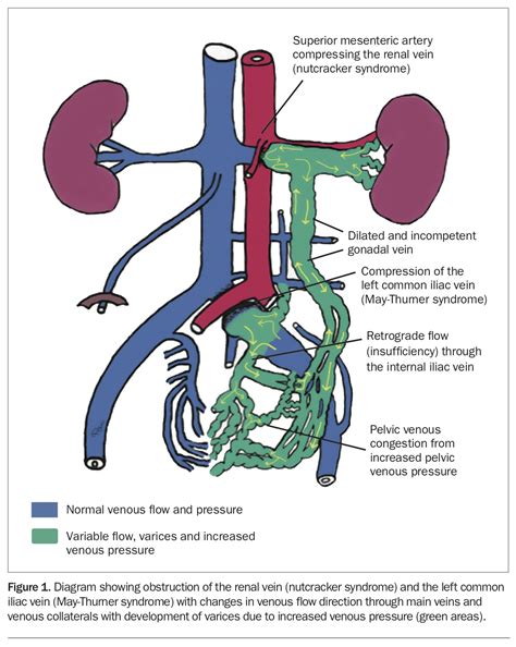 Gonadal Vein Anatomy Renal Vein Wikipedia