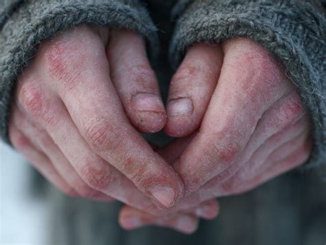 How To Heal Dry Chapped Hands And Keep Them Soft