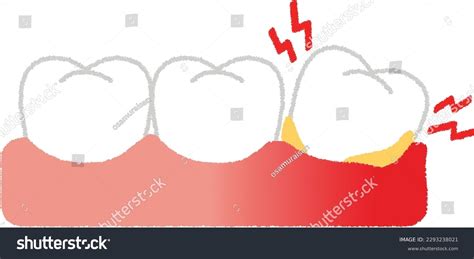 Alveolar Pyorrhea Condition Which Pus Leaks Stock Vector Royalty Free