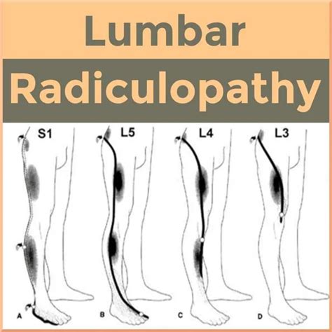 Lumbar Radiculopathy Sports Med Review