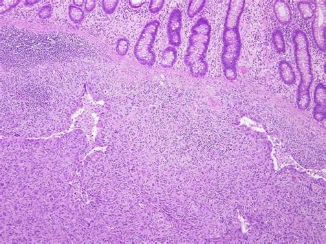 Follicular Dendritic Cell Sarcoma