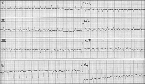 Ecg Learning Center An Introduction To Clinical Electrocardiography