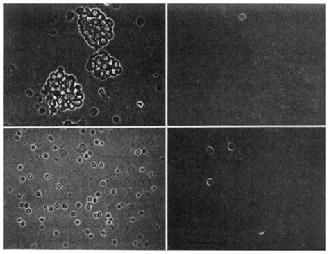 A Upper Left Lymph Node Lymphoma Cell Suspension Made At Autopsy