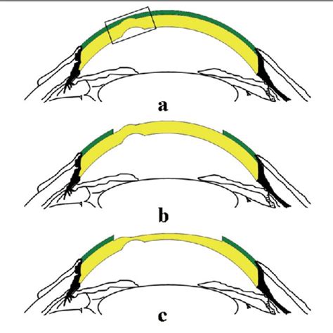 Pdf Topography Guided Excimer Laser Treatment