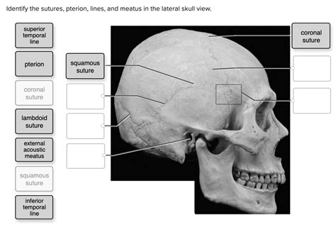 Identify The Sutures Pterion Lines And Meatus In The Lateral Skull