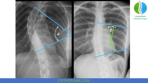 Cobb Angle For Scoliosis Explained Easily Orthofixar