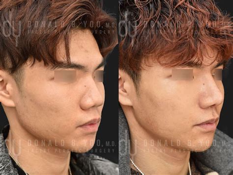 Gallery Surgical Asian Rhinoplasty