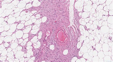 Diffuse Neurofibroma Archives Ottawa Atlas Of Pathology