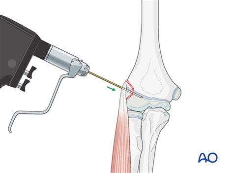 Open Reduction K Wire Fixation For Avulsion Of By The Lateral Collateral Ligament