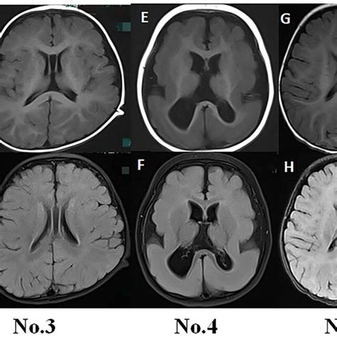 Typical Magnetic Resonance Imaging Mri Findings In Infantile Spasm Download Scientific