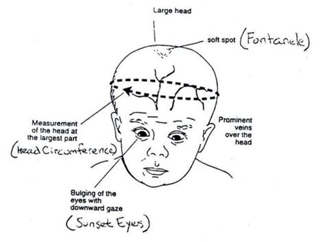 Sun Setting Eyes Pathophysiology
