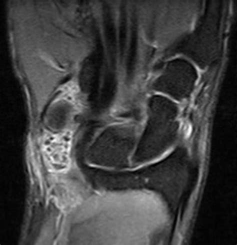 Pisotriquetral Joint Pathology Radsource