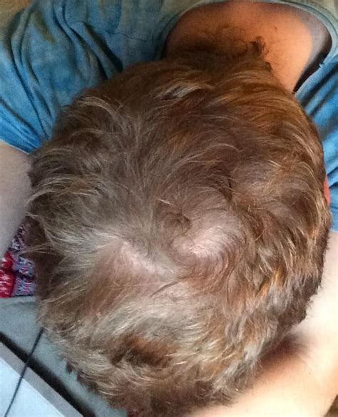 Dutasteride Results 1 Year Progress Before And After R Tressless