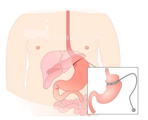 Laparotomy Vs Laparoscopy Full Article Minilaparotomy Vs Laparoscopic